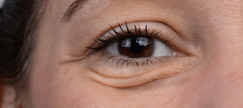 Waking Up With Puffy Eyes? Here’s What Your Skin Is Trying To Tell You ...