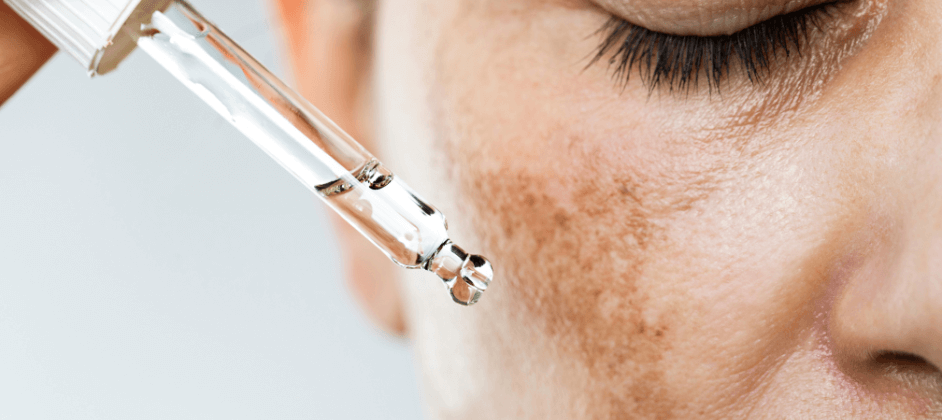 Uncovering the Culprits of Dark Spots: 3 Causes and Tips to Combat It ...